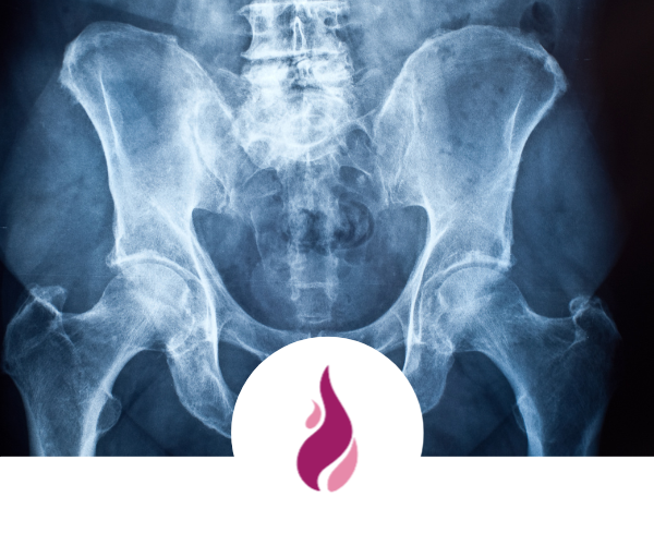 Menopause is Inevitable, Osteoporosis is Preventable - Menohealth